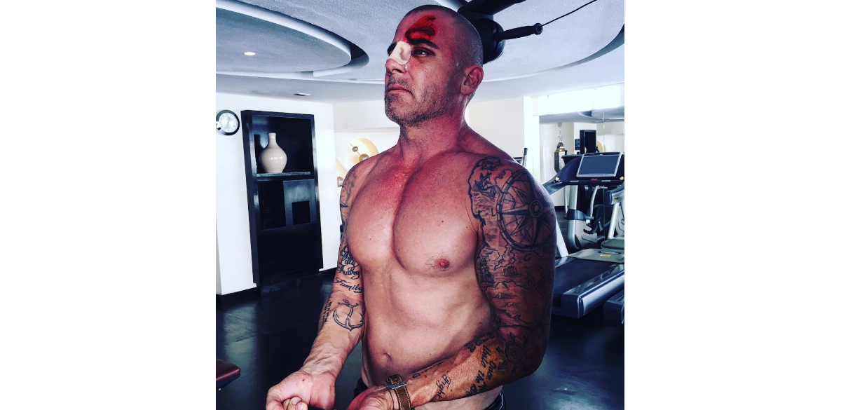 Photo : Dominic Purcell blessé après son accident sur le tournage de la ...