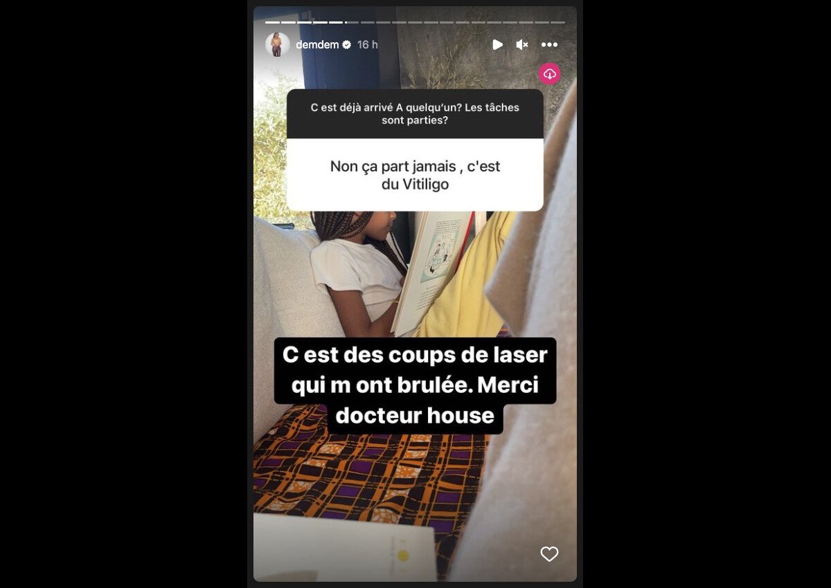 Photo : Demdem dévoile ses brûlures sur Instagram. Le 29 novembre 2022 ...