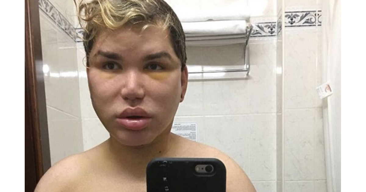 Rodrigo Alves : La santé du Ken humain est en danger après sa 50e ...