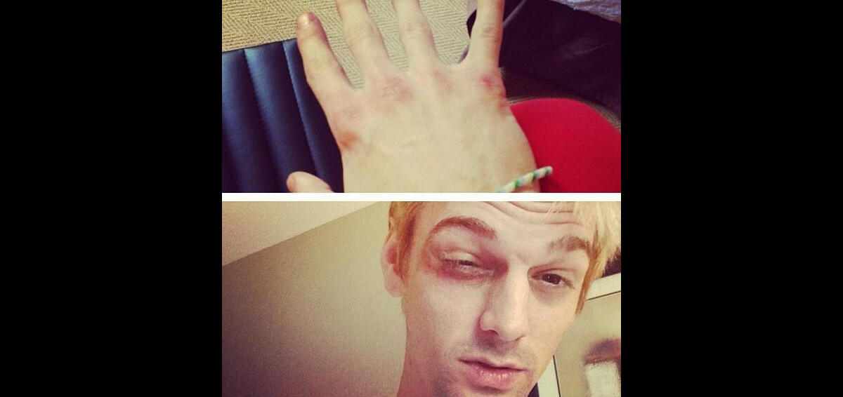 Photo : Aaron Carter a posté sur son Instagram des photos de son visage ...
