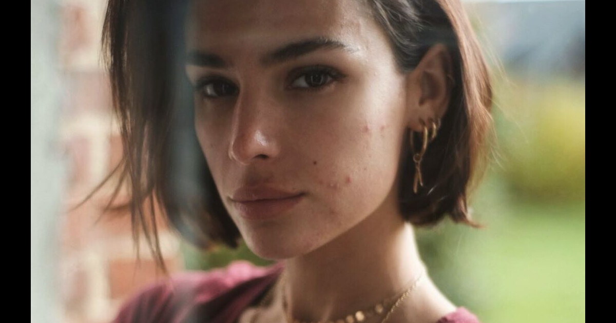Jade Leboeuf Assume Et Montre Son Acné Hormonale Cest Difficile