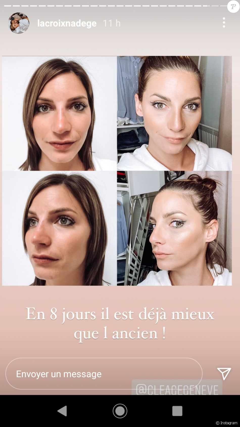Nadège Lacroix dévoile son nouveau nez sur Instagram, le 16 décembre ...
