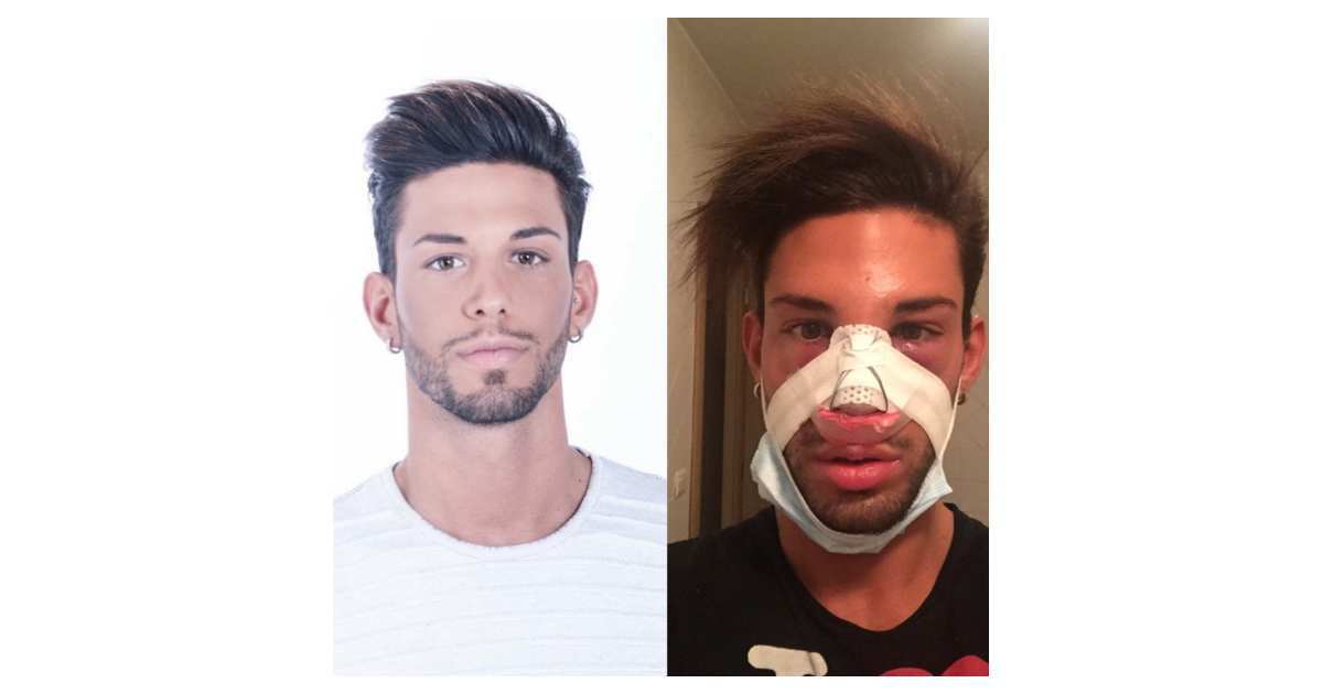 Sacha Buyse (Secret Story 8) : Méconnaissable après une rhinoplastie ...