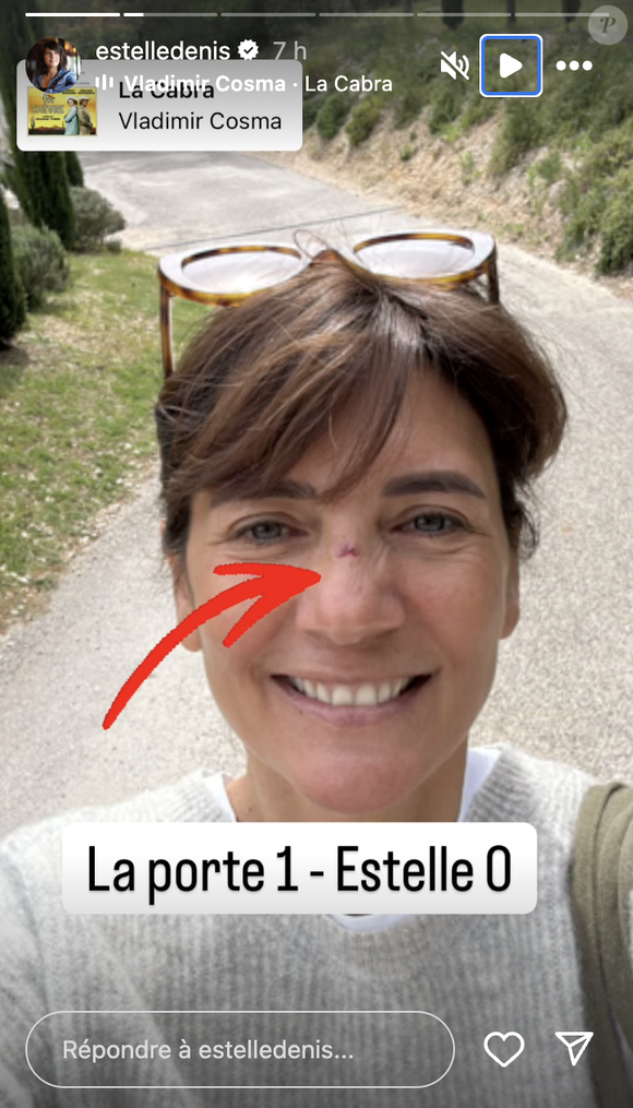 Estelle Denis amochée au visage après un incident survenu pendant ses vacances avec son ...